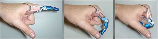 Finger Amputees Return to Daily Activities with New Device - The O&P ...