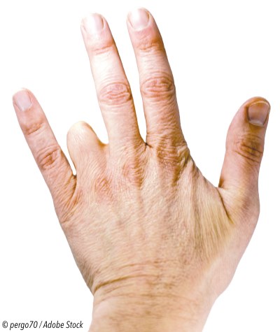 Updates on Prosthetic Rehabilitation Following Partial Hand Amputation ...