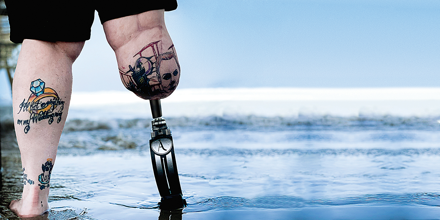 The Present and Future of Osseointegration - The O&P EDGE Magazine