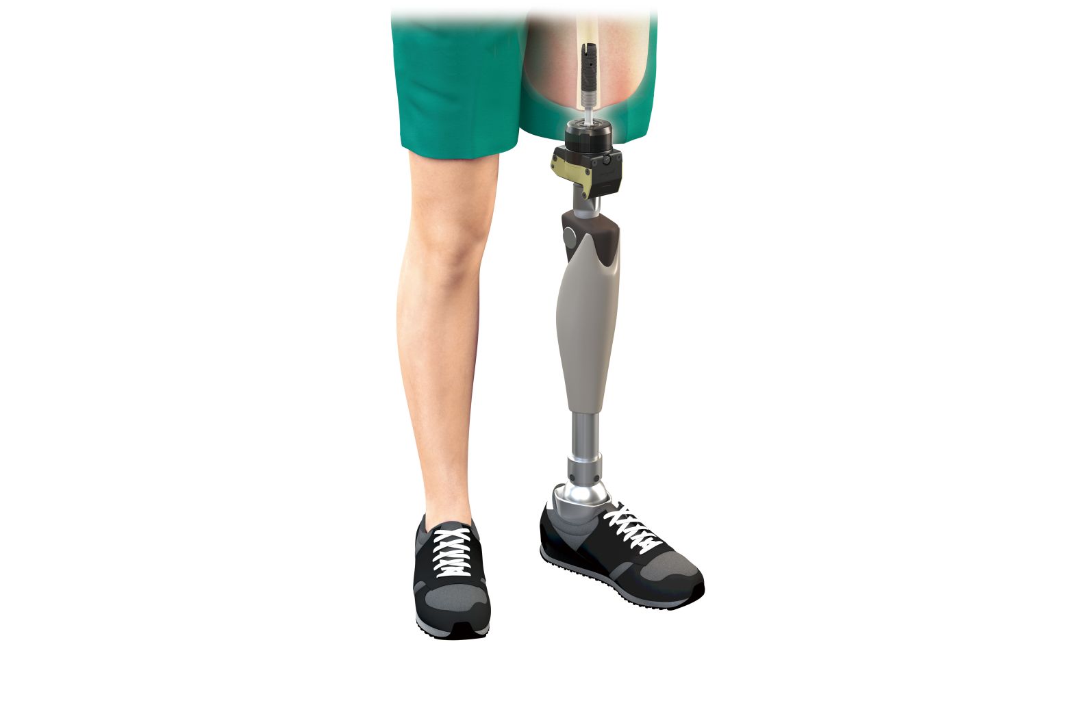New York Medical Center Launches Osseointegration Program - The O&P ...