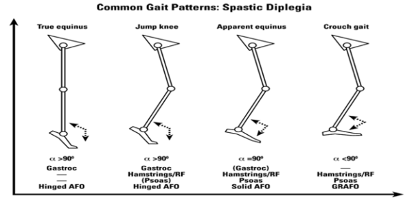Orthotics and Their Role in Improving Gait and Treating Deformities in ...